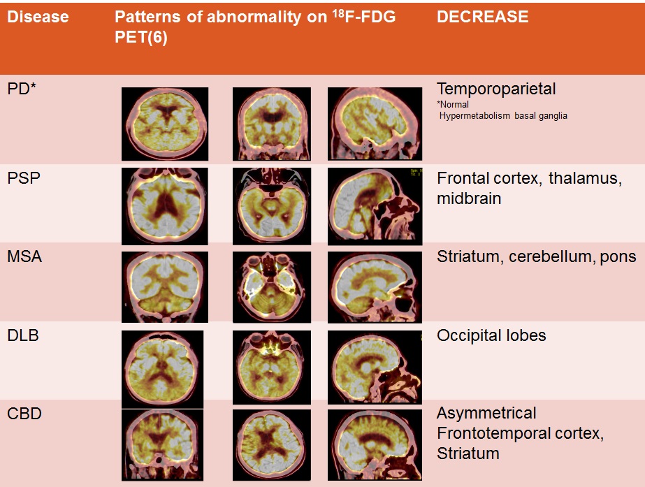 18F-FDG PET brain in Parkinsonism - MDS Abstracts